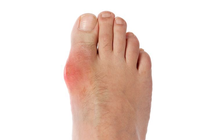 Ουρική αρθρίτιδα (ποδάγρα) | Bioenergy Medical | Πρότυπες Ιατρικές ...